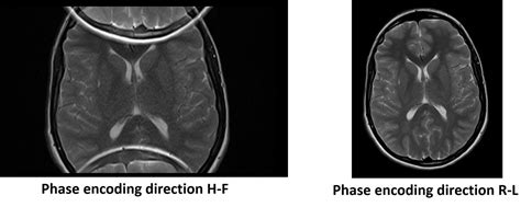 Phase Encoding In MRI MRI Phase Encoding Direction