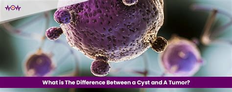 What Is The Difference Between A Cyst And A Tumor Wow Health