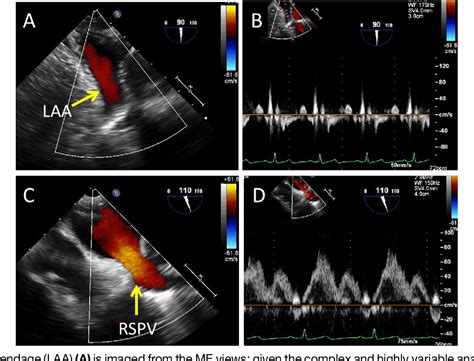 Figure 8 From Guidelines For Performing A Comprehensive Transesophageal Echocardiographic