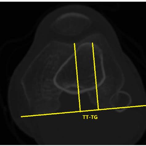 A Sulcus Angle Sa B Lateral Trochlear Inclination Lti Medial Download Scientific Diagram