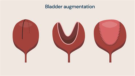 Bladder Augmentation And Mitrofanoff Procedure For High Pressure Or