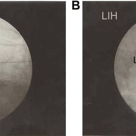 Blockade Of The Superior Hypogastric Plexus Lateral View Notes 1 Download Scientific