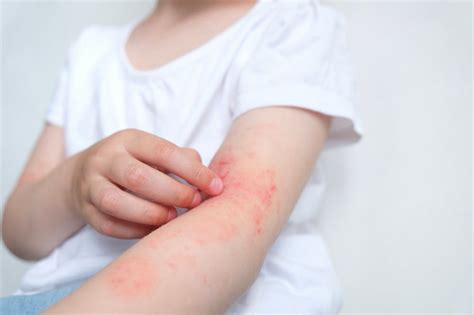 Why Is Eczema Sometimes Treated With A Diluted Bleach Bath And What Do