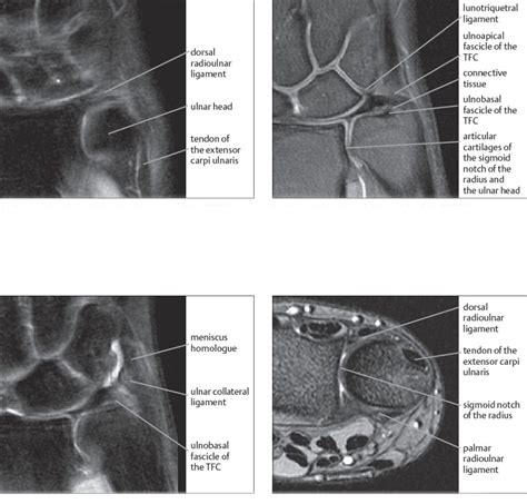 11 Triangular Fibrocartilage Complex Radiology Key