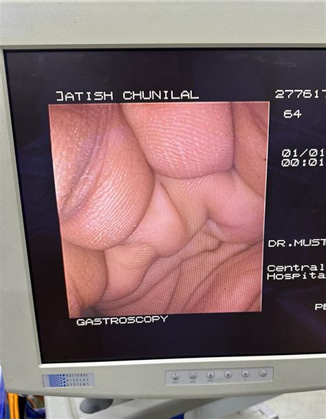 Endoscopy System → Medicrelove