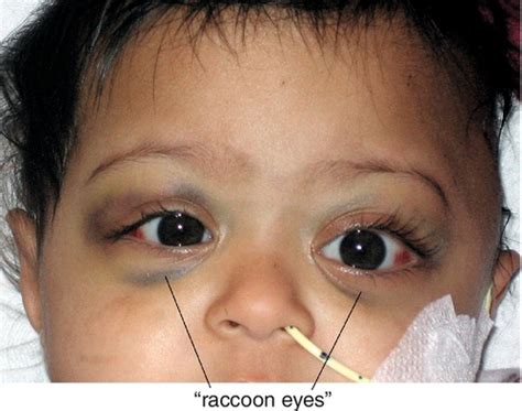 Raccoon Eyes Differential Diagnosis