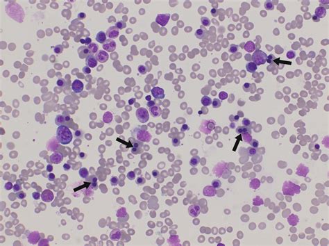 Bone Marrow Aspirate From Our Patient Showing Erythroid Download