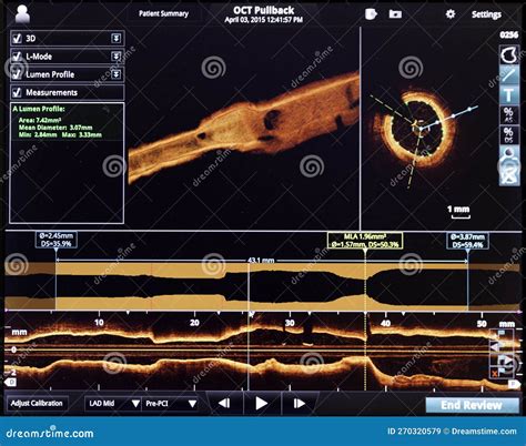 Optical Coherence Tomography Oct Image Angiography Catheter Lab Atherosclerosis Royalty Free