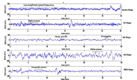 Figure 1 From Detection Of Eeg K Complexes Using Fractal Dimension Of