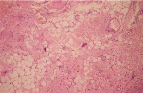 Photomicrograph Of Hand E Section Showing Infilt Ration Of Adipocytes Download Scientific