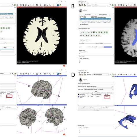 Segmentation Of The Brain Parenchyma And Lateral Ventricles With A