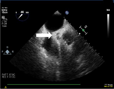 A Perivalvular Echolucent Area Compatible With An Aortic Root Abscess Download Scientific Diagram