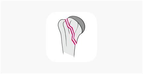 ‎classify Fracturecode On The App Store