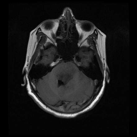Diffuse Brainstem Glioma Radiology Case Radiopaedia Org