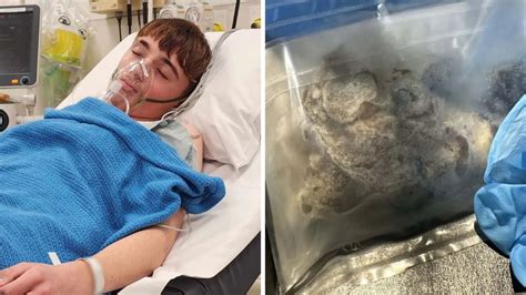 ‘black Chunks Shocking Pics Show Why You Shouldnt Vape Au — Australias Leading