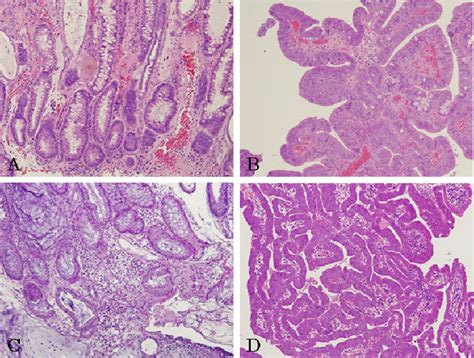 Histopathological Findings Of The Colorectal Polyps Case 1 A B And