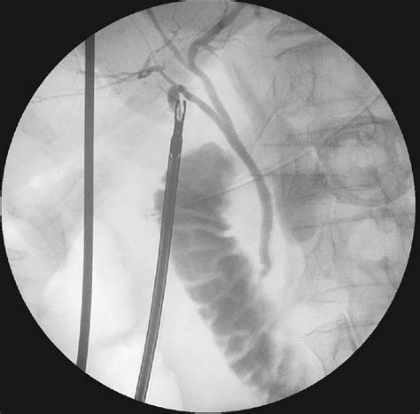 Gallbladder And Biliary Tree Clinical Tree