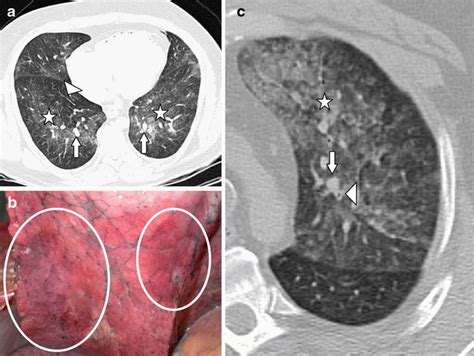 Drowning—post Mortem Imaging Findings By Computed Tomography Springerlink