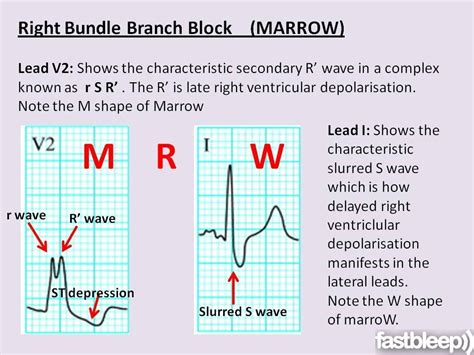 Right Bundle Branch Block Rbbb Almost Always Has A Pathological Cause Common Pathologies
