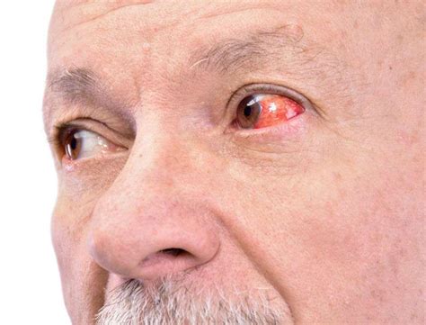 “红眼病”就是结膜炎？医生：结膜炎通常有这几种类型，要分清楚患者发病症状