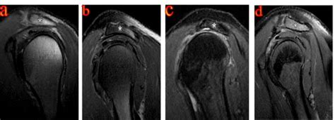 Acromion Types