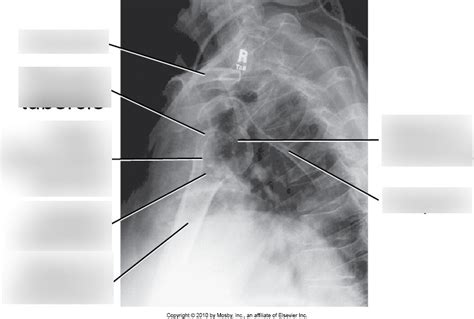 Transthoracic Lateral R Shoulder Anatomy Diagram Quizlet
