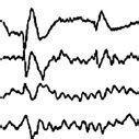 Note The Frequent Spike Wave Discharges That Phase Reverse Over The Download Scientific Diagram