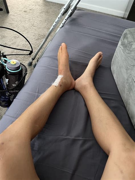 Fractured Distal Tibia And Fibula 3 Wks Post Op My Experience Long
