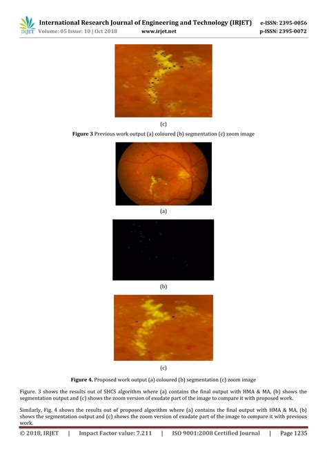 Irjet Application Of False Removal Algorithm Specially For Retinal Images With Exudates In