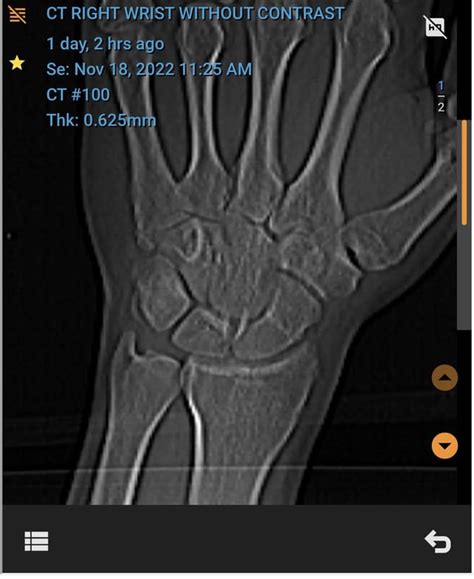Scaphoid Waist Fracture Non Displaced Ct Scan Is 6 Weeks Post