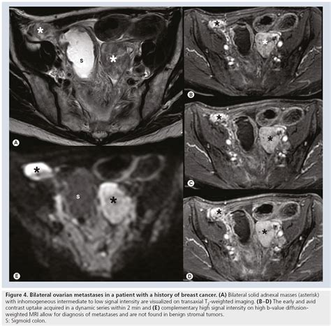 Mri In Ovarian Cancer