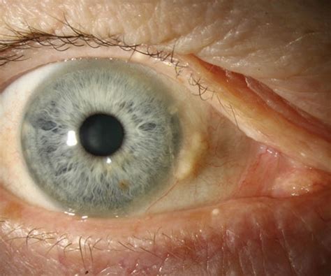 Limbal Follicles