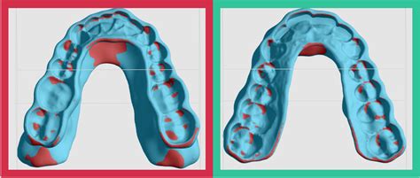 Keyprint Keysplint Soft Clear Materials