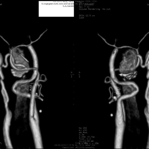 Posterolateral Left And Posterior Right Views Of Postauricular