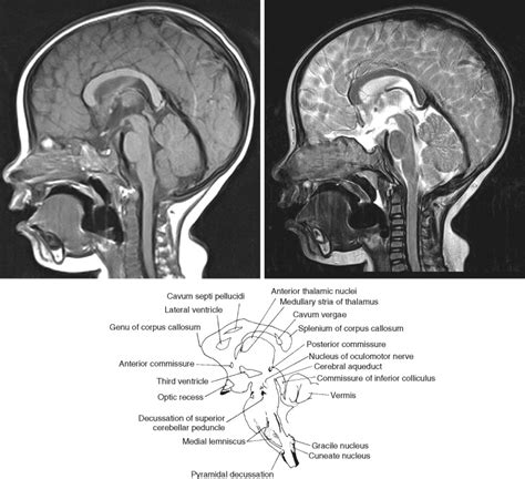 Sectional Anatomy Of The Postnatal Brain Radiology Key