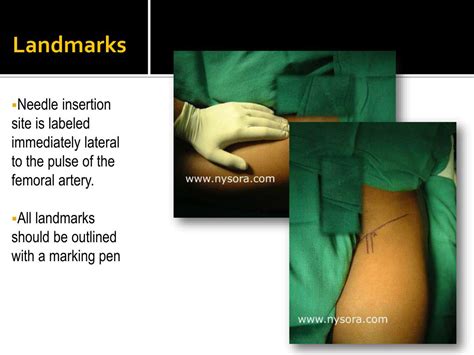 PPT Lumbar Plexus Block Femoral Nerve Block PowerPoint Presentation ID