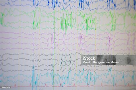 비정상적인 뇌 뇌 파 뇌 파의 전기 활동을 보여주는 컴퓨터 모니터 뇌졸중에 대한 스톡 사진 및 기타 이미지 뇌졸중 부재