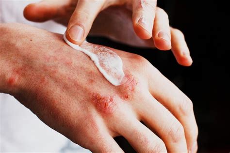 Understanding The Different Types Of Eczema Garden City Ny And Syosset