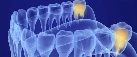 What Are The Steps Of Tooth Extraction A Comprehensive Guide