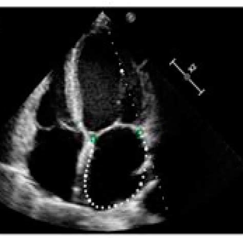 A Right Ventricular Speckle Tracking Analysis Global Rv Longitudinal Download Scientific