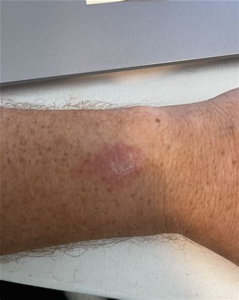 My new Garmin Fénix x sapphire solar sensor are burning my skin so bad Any reported issue like