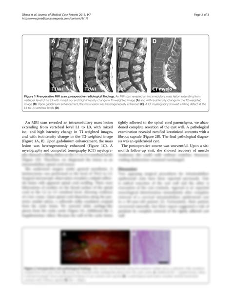 Solution Elderly Onset Intramedullary Epidermoid Cyst In The Conus Medullaris A Case Report