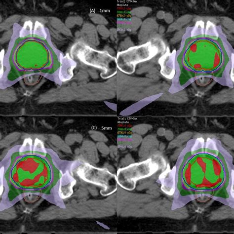 Pdf Determination Of Optimal Ptv Margin For Patients Receiving Cbct Guided Prostate Imrt