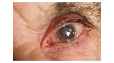 Guide To Intracapsular Cataract Extraction Icce Obn