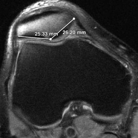 Mri Quantitative Morphologic Analysis Of Patellofemoral Region Lack Of