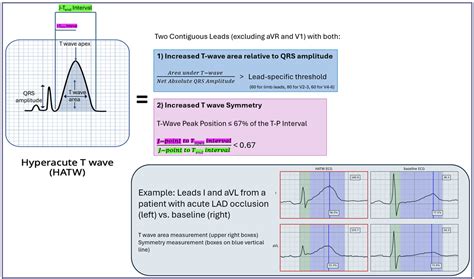 First Objective Definition Of Hyperacute T Waves As A St Segment Elevation Myocardial Infarction