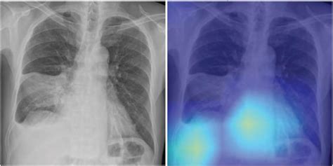 Deep Learning Chest X Ray Model Predicts Mortality For Community Acquired Pneumonia Axis