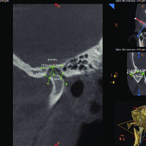 Pdf Assessment And Comparison Of Condylar Position Based On Joint Space Dimensions And Gelb 4