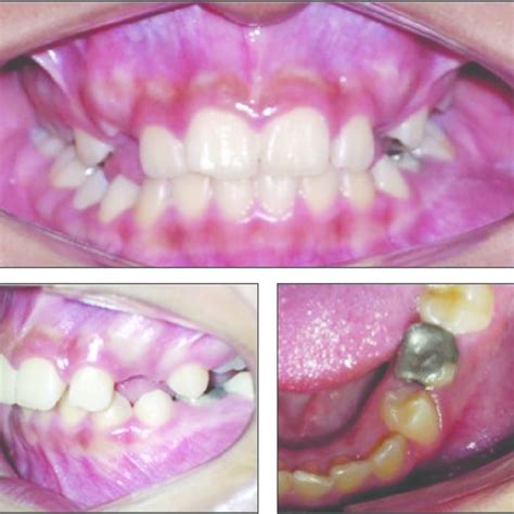 Pdf Spontaneous Eruption Of Premolar Associated With A Dentigerous Cyst
