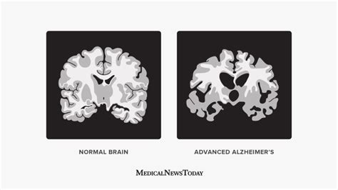 Alzheimers Brain Vs Typical Brain Differences In Function